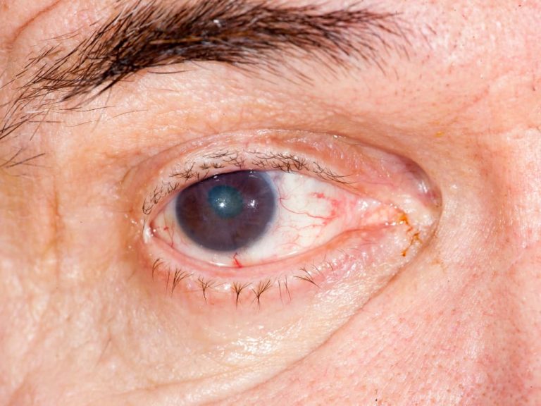 Conheça 5 Doenças Oculares Comuns e que Precisam de Atenção