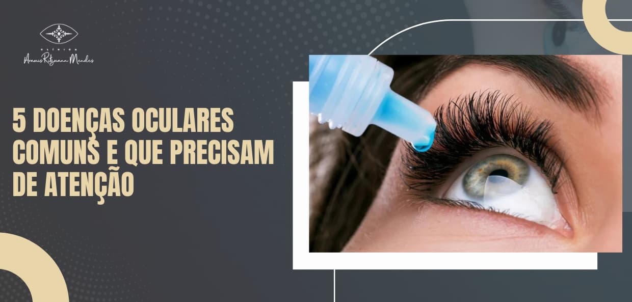 Conheça 5 Doenças Oculares Comuns e que Precisam de Atenção